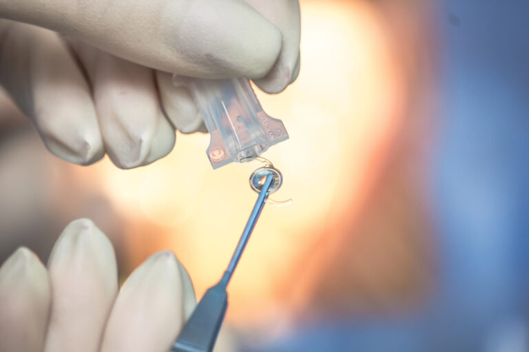 Quanto custa lente intraocular na cirurgia de catarata?