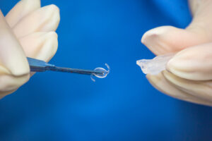 Quanto custa lente intraocular na cirurgia de catarata?